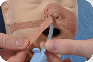 Nasal tracheal tube taping - PICU SOP | NHSGGC